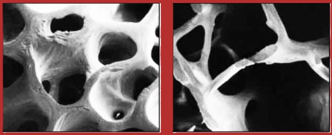 Medications That May Increase Osteoporosis Risk – Irene Pastore Fitness.com